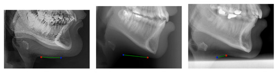 Cephalometric Landmark Detection in Lateral Skull X-ray Images by Using ...