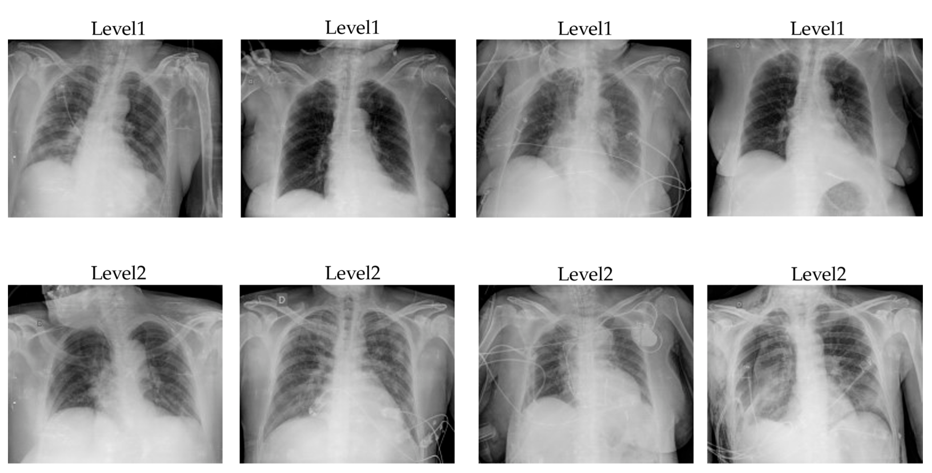 COVID-19 Chest X-ray Classification and Severity Assessment Using Convolutional and Transformer ...