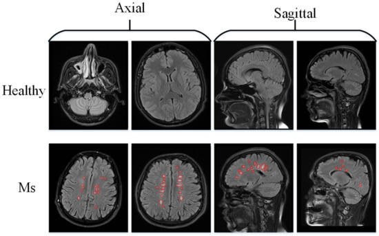 An Accurate Multiple Sclerosis Detection Model Based on Exemplar Multiple Parameters Local Phase ...