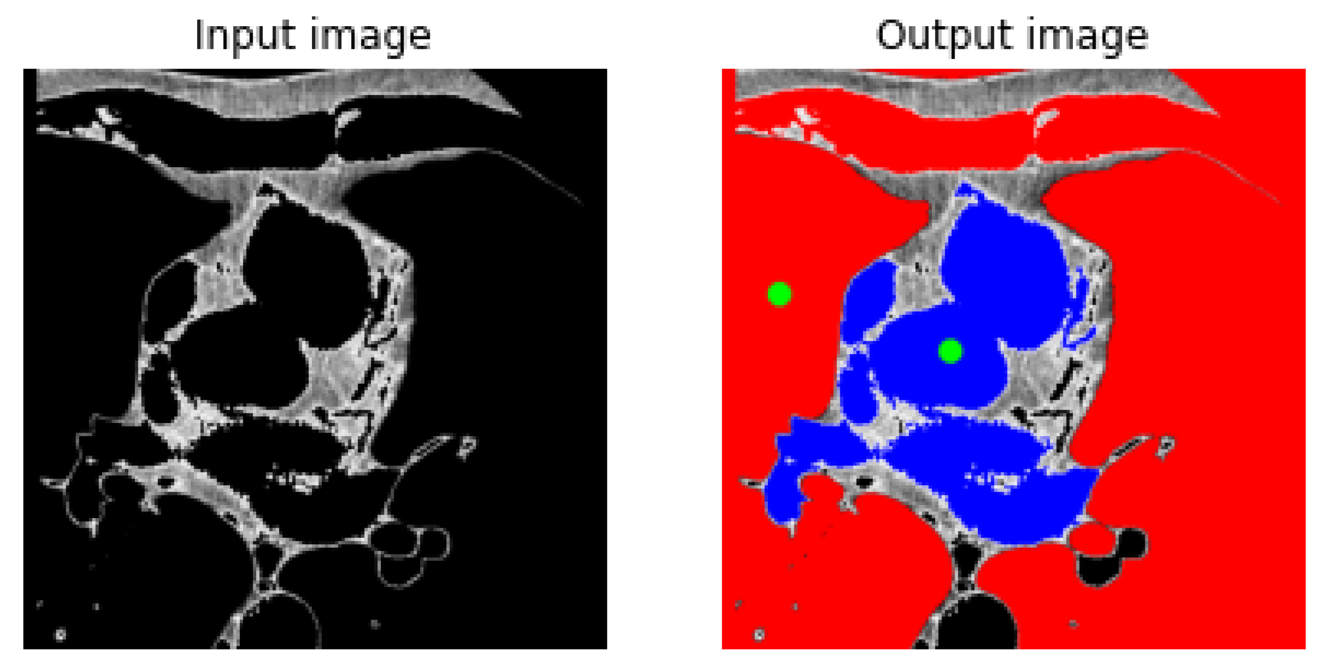 Recent Progress in Epicardial and Pericardial Adipose Tissue ...