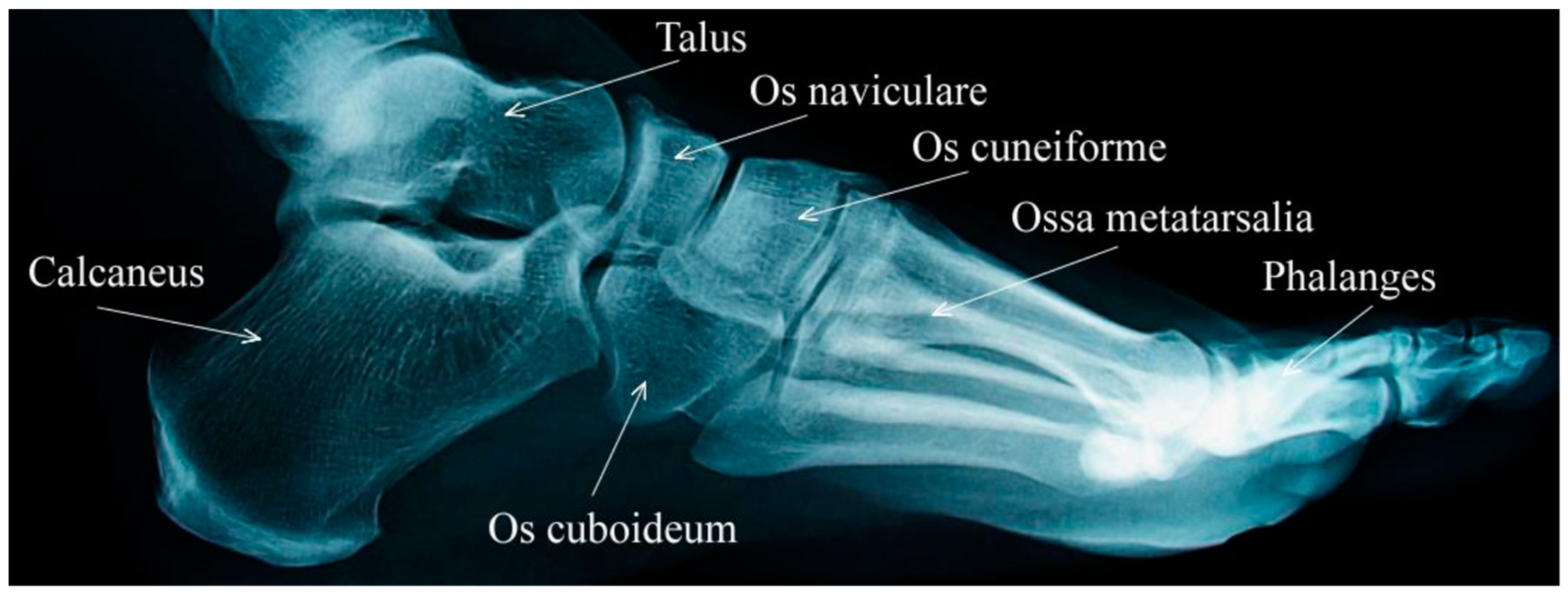 Numerical Analysis of the Calcaneal Nail C-NAIL