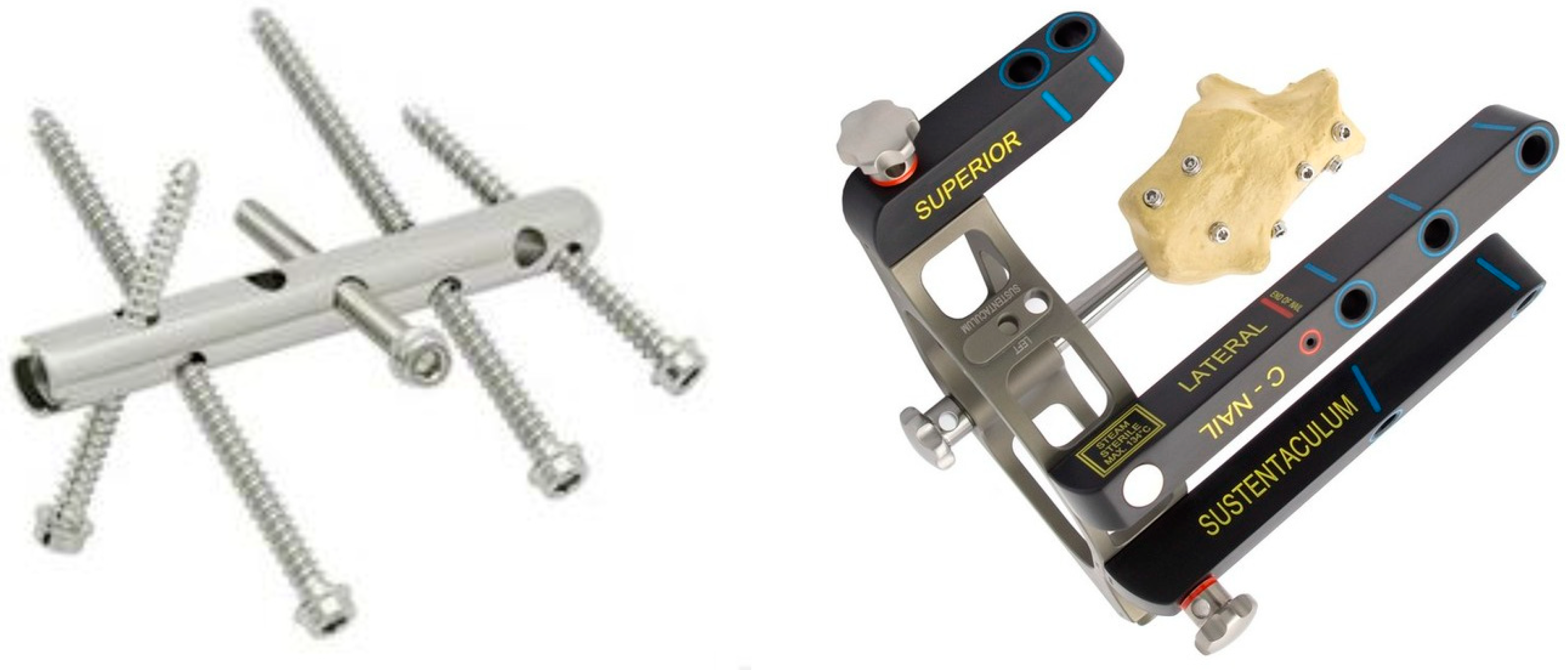 Numerical Analysis of the Calcaneal Nail C-NAIL