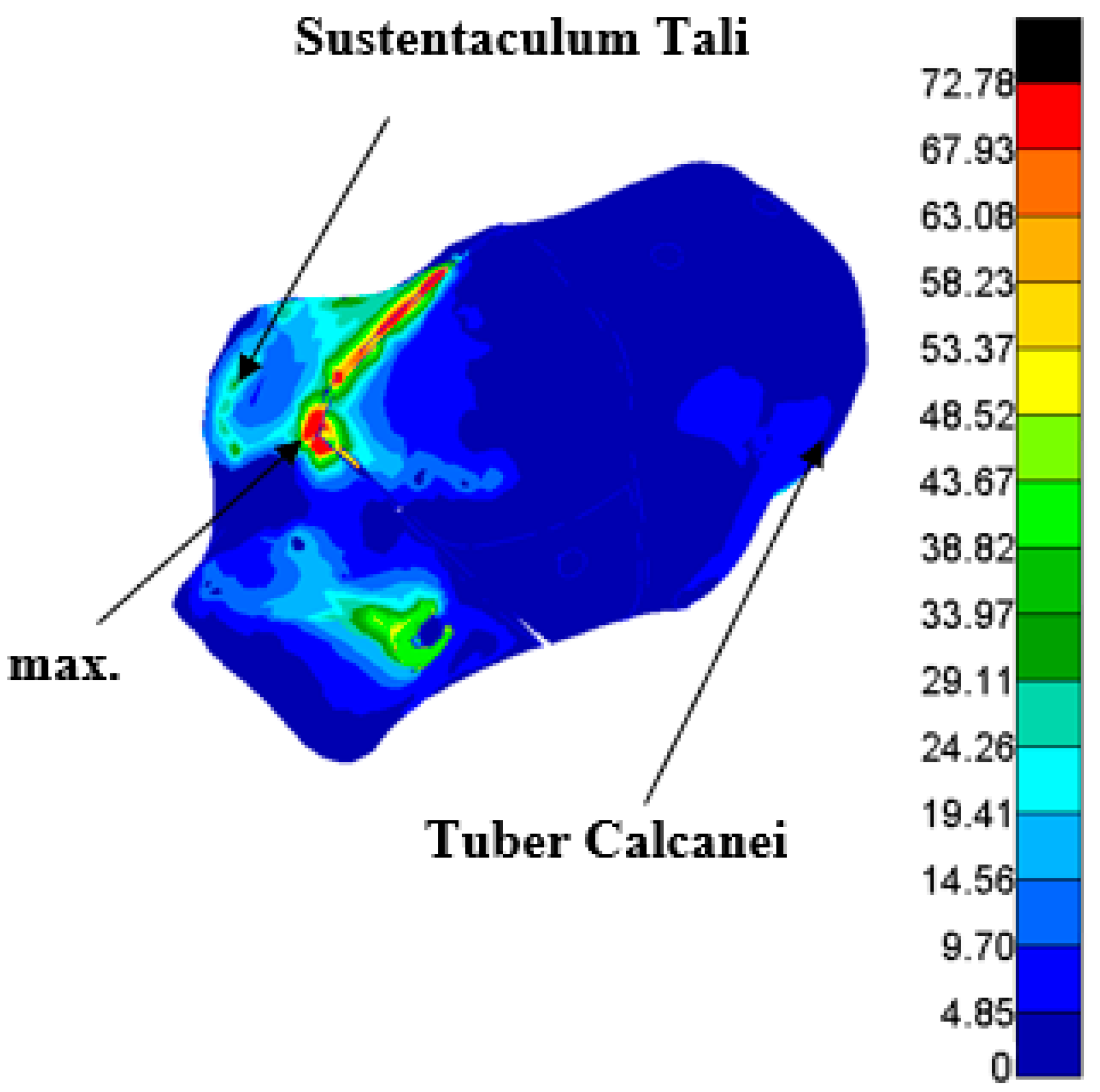 Numerical Analysis of the Calcaneal Nail C-NAIL