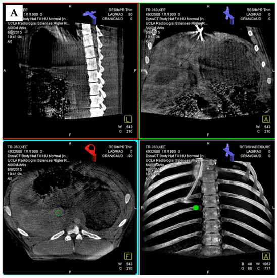Applied Sciences | Free Full-Text | Single Puncture TIPS—A 3D Fusion ...