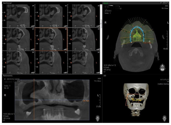 Applied Sciences | Free Full-Text | Maxillary Sinus Osteoma as a ...