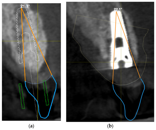 Evaluation of Deviations between Computer-Planned Implant Position and ...