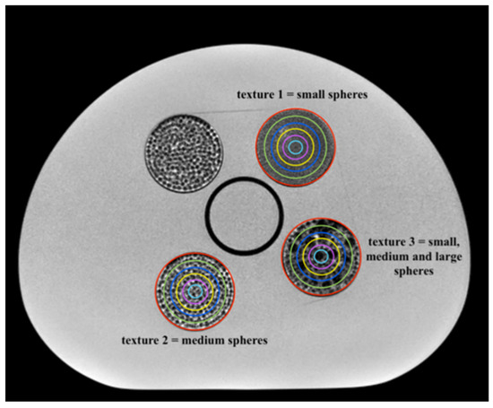 Discrimination of Tumor Texture Based on MRI Radiomic Features: Is ...