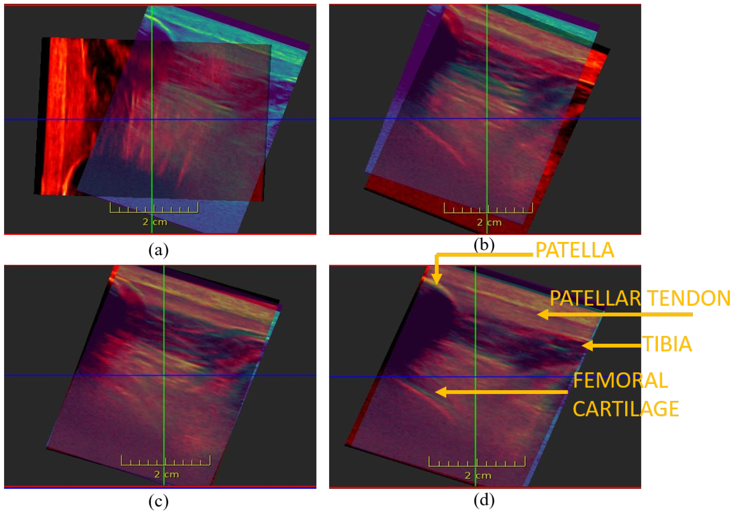 Automatic 3D MRI-Ultrasound Registration for Image Guided Arthroscopy