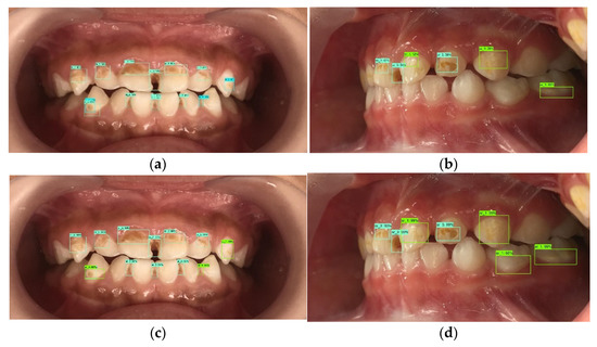 Deep Learning Application in Dental Caries Detection Using Intraoral Photos Taken by Smartphones