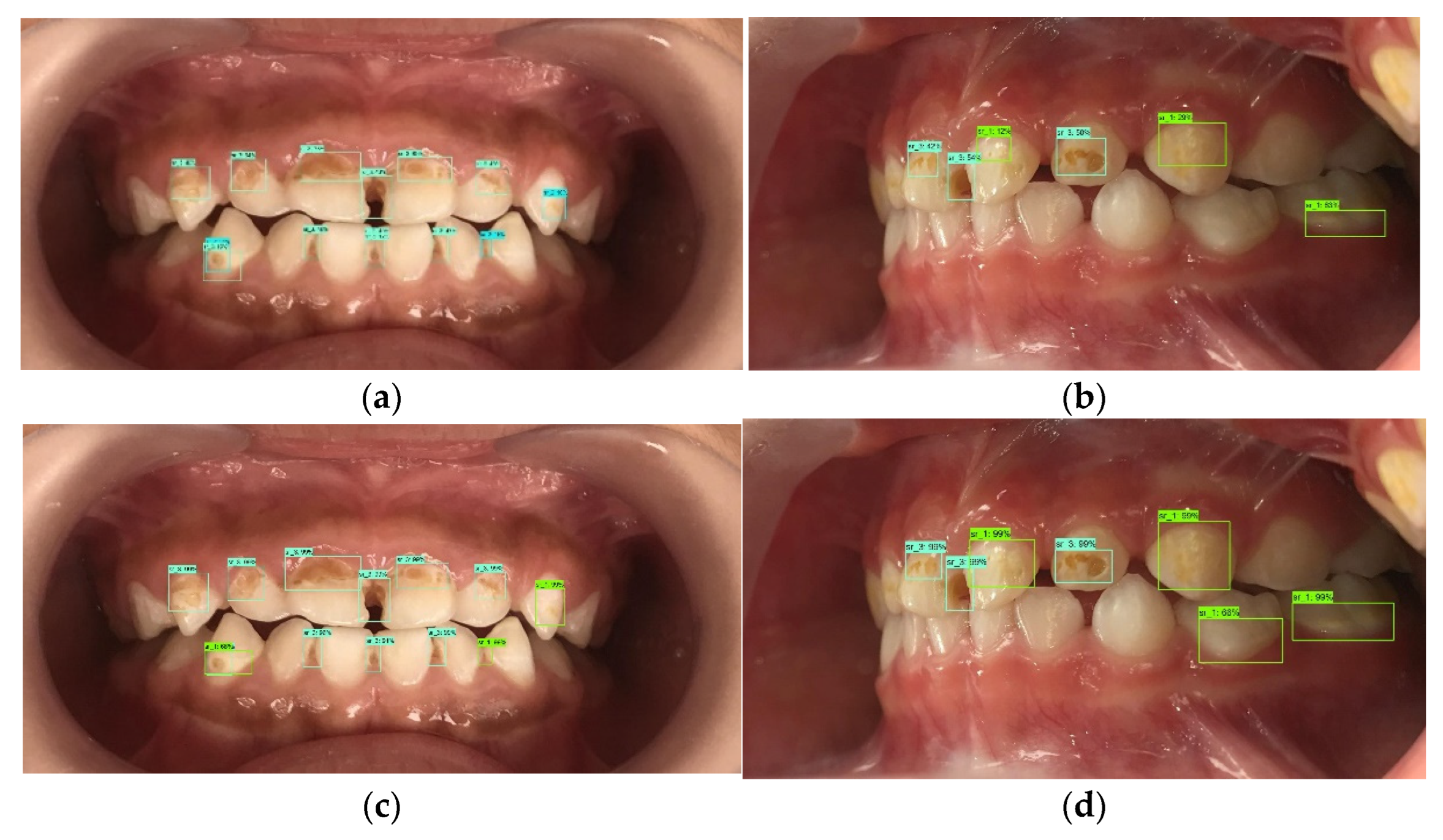 Flowchart Of The Detection Of Dental Caries In The Deep Learning Model