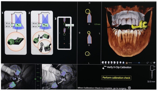 Dynamic Navigation System for Immediate Implant Placement in the ...