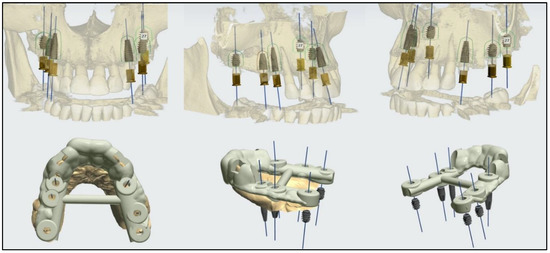 Digital Planning Technique for Surgical Guides for Prosthetic Implants ...