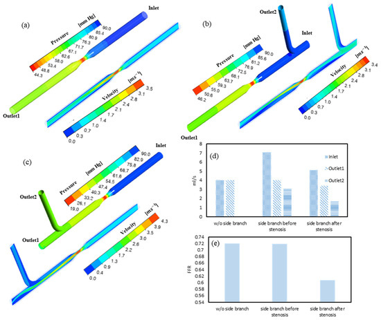Fractional Flow Reserve (FFR) Estimation from OCT-Based CFD Simulations ...