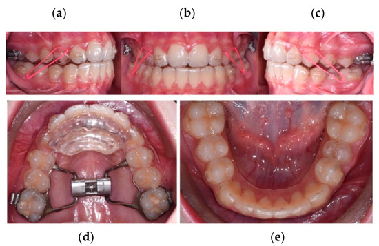 Class II Treatment in Growing Patients: Preliminary Evaluation of the ...
