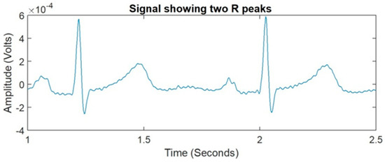Complexity Analysis in the PR, QT, RR and ST Segments of ECG for Early ...