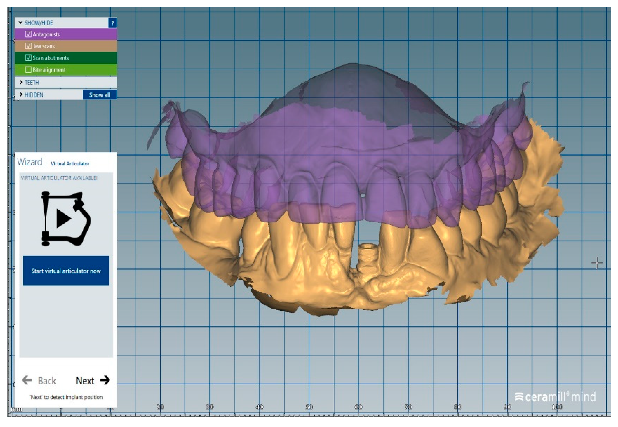 Extraoral Scanning of Implant Prosthetic Components under Difficult ...