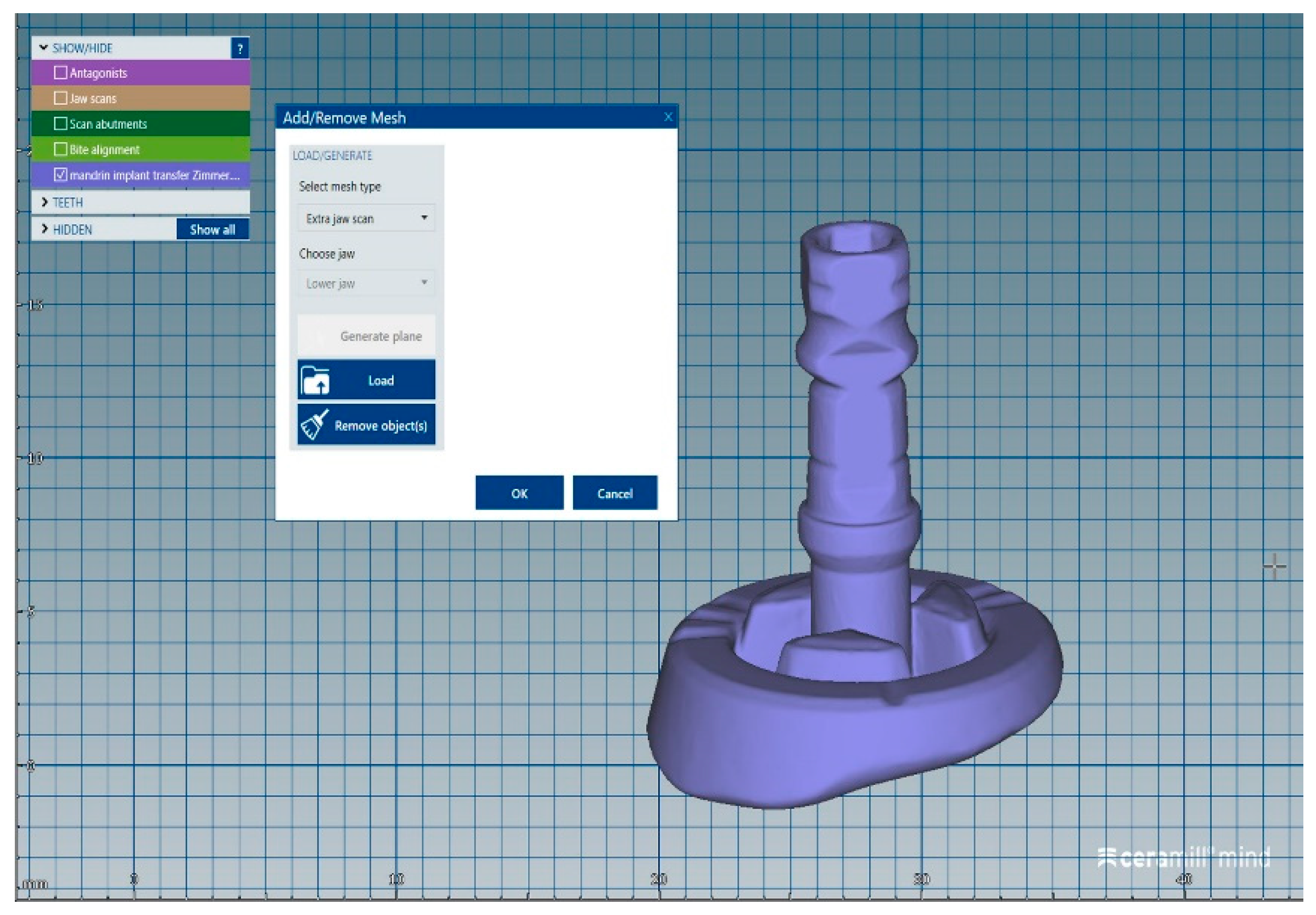 Extraoral Scanning of Implant Prosthetic Components under Difficult ...