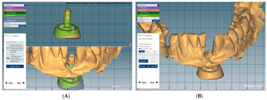 Extraoral Scanning of Implant Prosthetic Components under Difficult ...