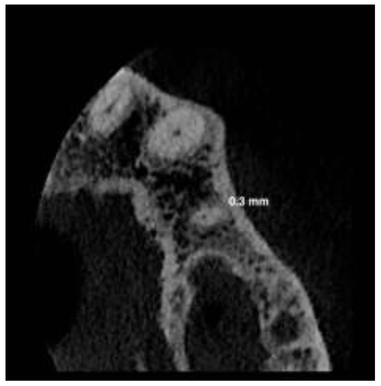 Three-Dimensional Evaluation of the Root Apex of Permanent Maxillary ...