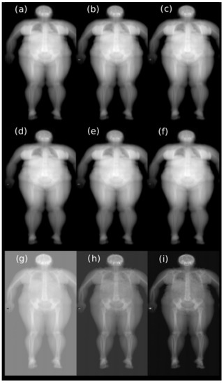 Age Prediction from Low Resolution, Dual-Energy X-ray Images Using ...