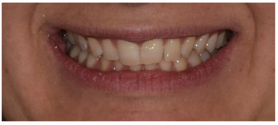 Deep Bite Treatment with Aligners: A New Protocol