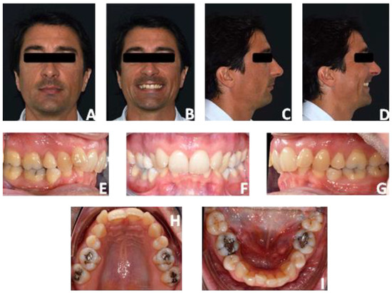 Deep Bite Treatment with Aligners: A New Protocol