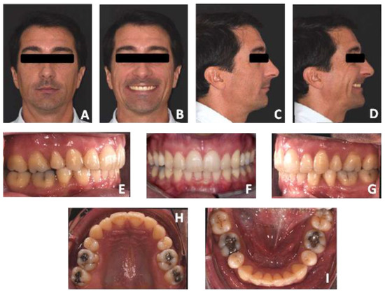 Deep Bite Treatment with Aligners: A New Protocol