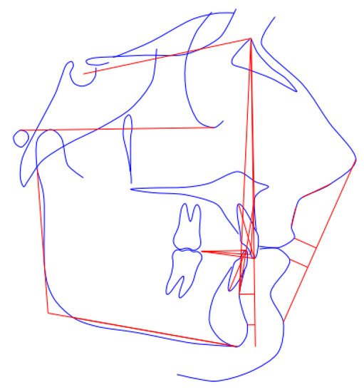Deep Bite Treatment with Aligners: A New Protocol