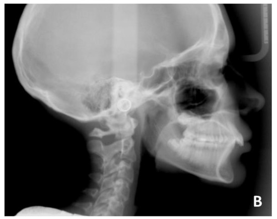 Deep Bite Treatment with Aligners: A New Protocol