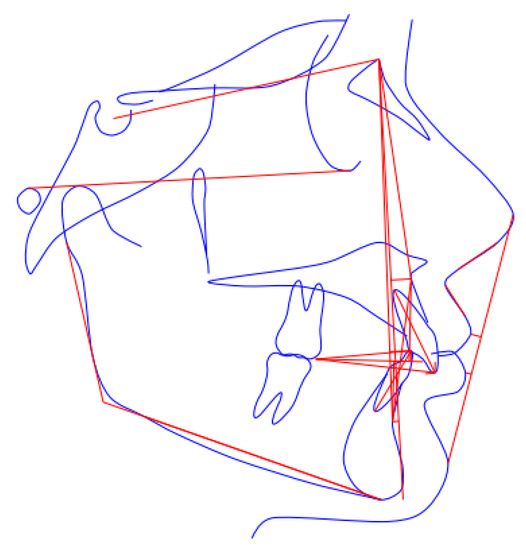 Deep Bite Treatment with Aligners: A New Protocol