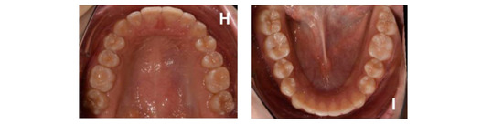 Deep Bite Treatment with Aligners: A New Protocol
