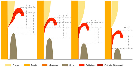 Assessment of Negative Gingival Recession: A Critical Component of ...