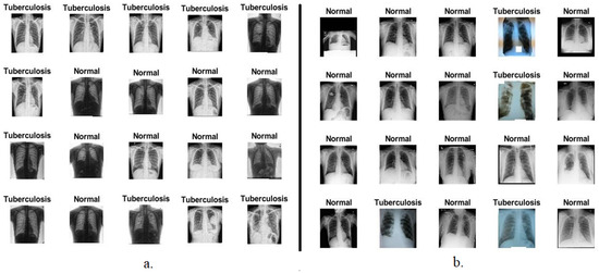 Deep and Hybrid Learning Technique for Early Detection of Tuberculosis ...
