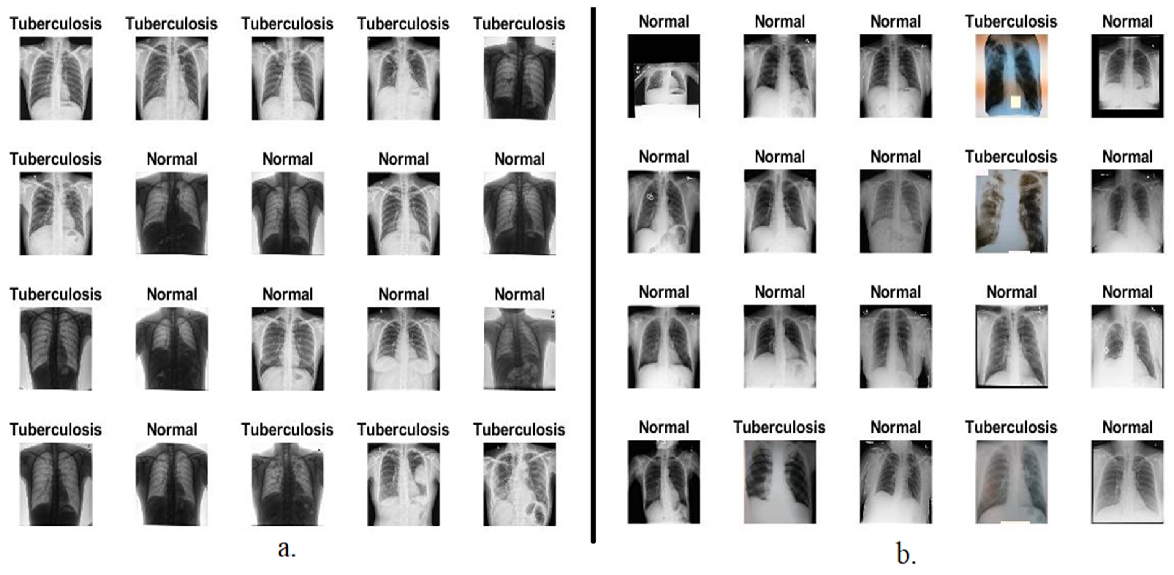 Deep and Hybrid Learning Technique for Early Detection of Tuberculosis ...