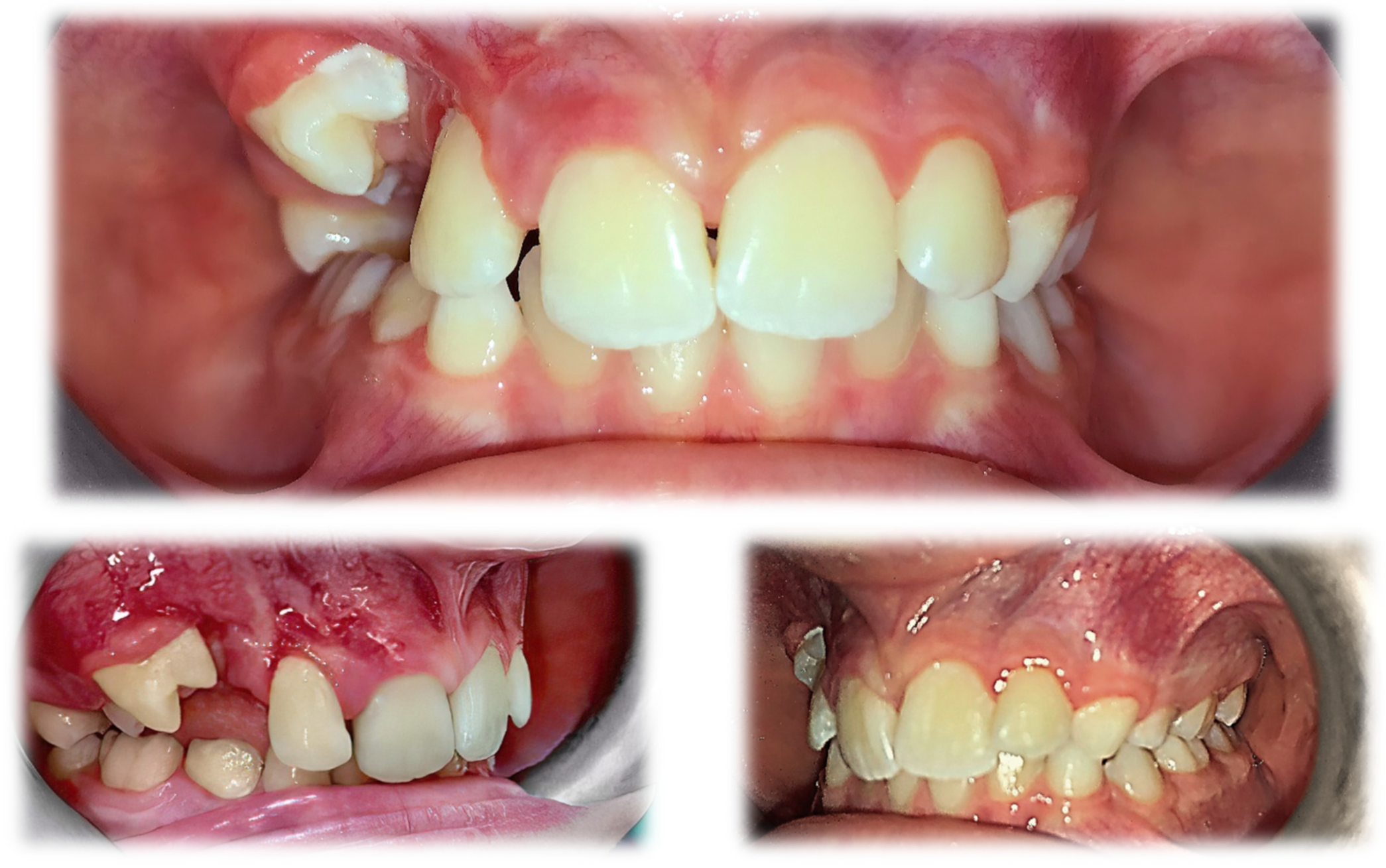 The Interdisciplinary Orthodontic–Surgical Diagnostic and Treatment ...