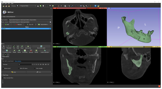 Three-Dimensional Analysis of Bone Volume Change at Donor Sites in ...