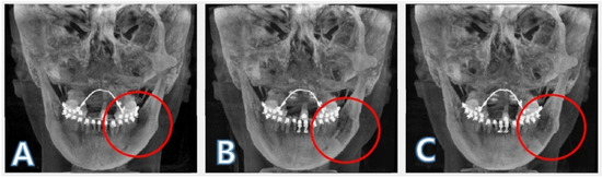 Three-Dimensional Analysis of Bone Volume Change at Donor Sites in ...