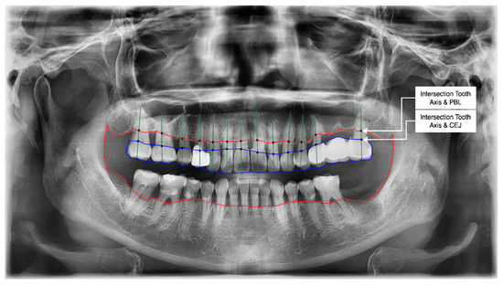 Deep Learning Model for Classifying Periodontitis Stages on Dental ...