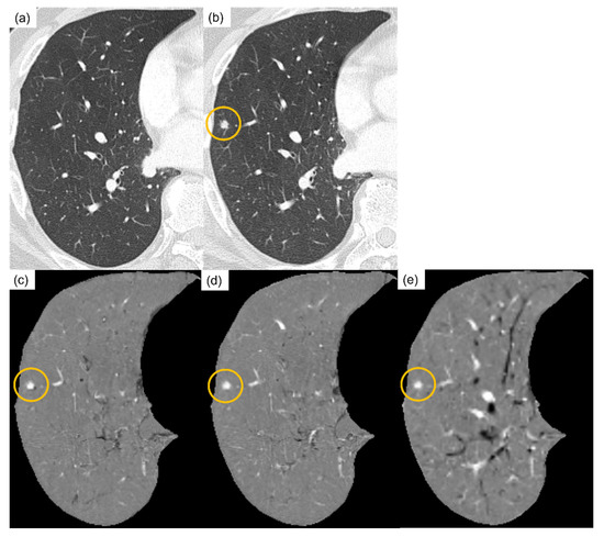 Temporal Subtraction Technique for Thoracic MDCT Based on Residual VoxelMorph
