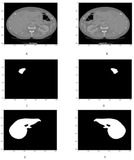 Segmentation of Liver Tumor in CT Scan Using ResU-Net