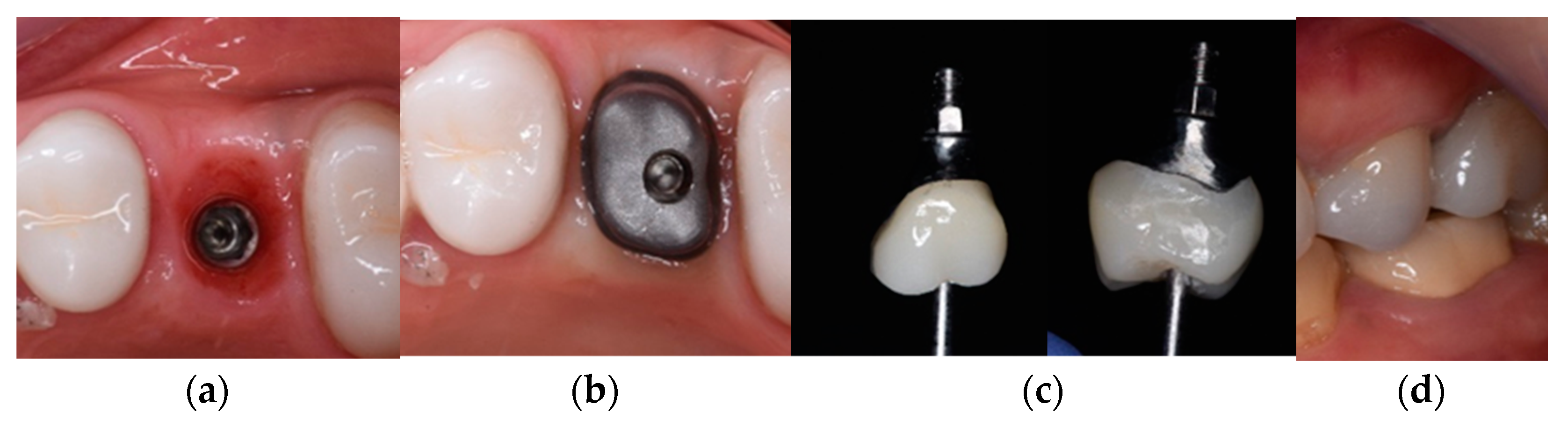 Clinical Evaluation of Implant Suprastructures Depending on the ...