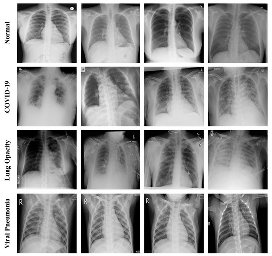 A Two-Step Learning Model for the Diagnosis of Coronavirus Disease-19 ...