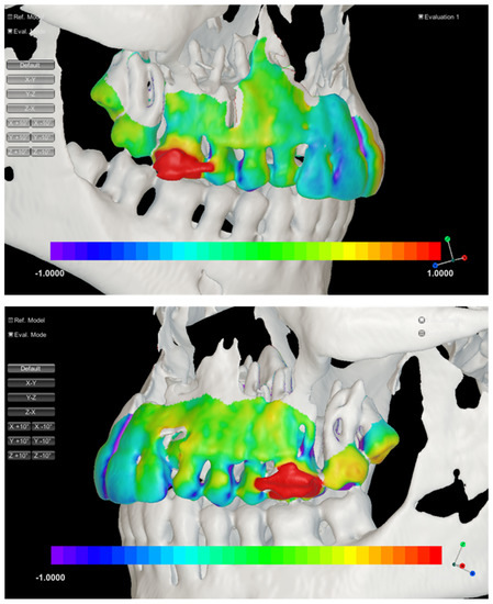 Premolar and Molar Inclination Changes Following Micro-Implant-Assisted ...