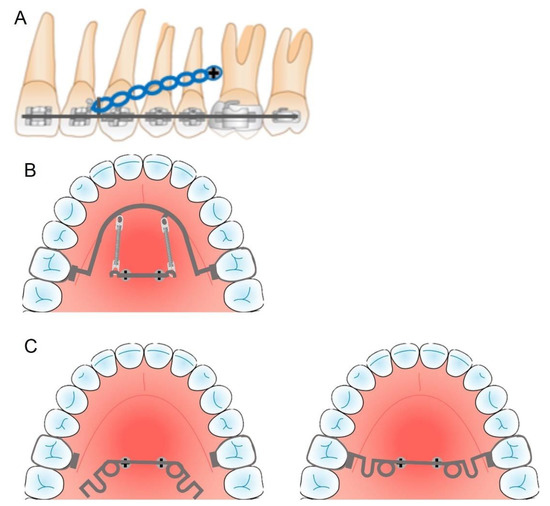 Occlusal Plane Changes after Maxillary Molar Distalization Using Temporary Skeletal Anchorages ...