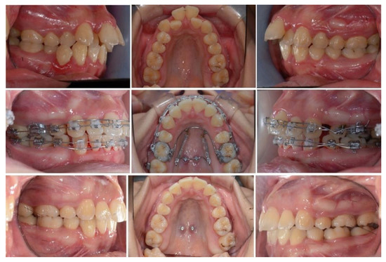 Occlusal Plane Changes after Maxillary Molar Distalization Using ...