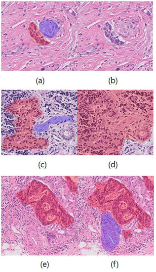 Automated Hybrid Model for Detecting Perineural Invasion in the ...