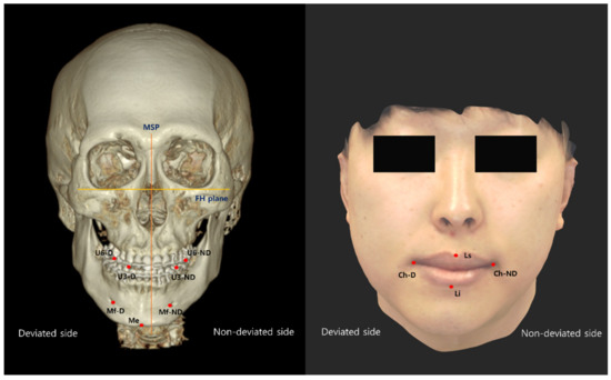 Three-Dimensional Change of Lip after Two-Jaw Surgery in Facial ...