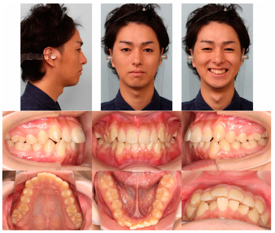 A Case Treated with Maxillary Molar Distalization through the Maxillary ...