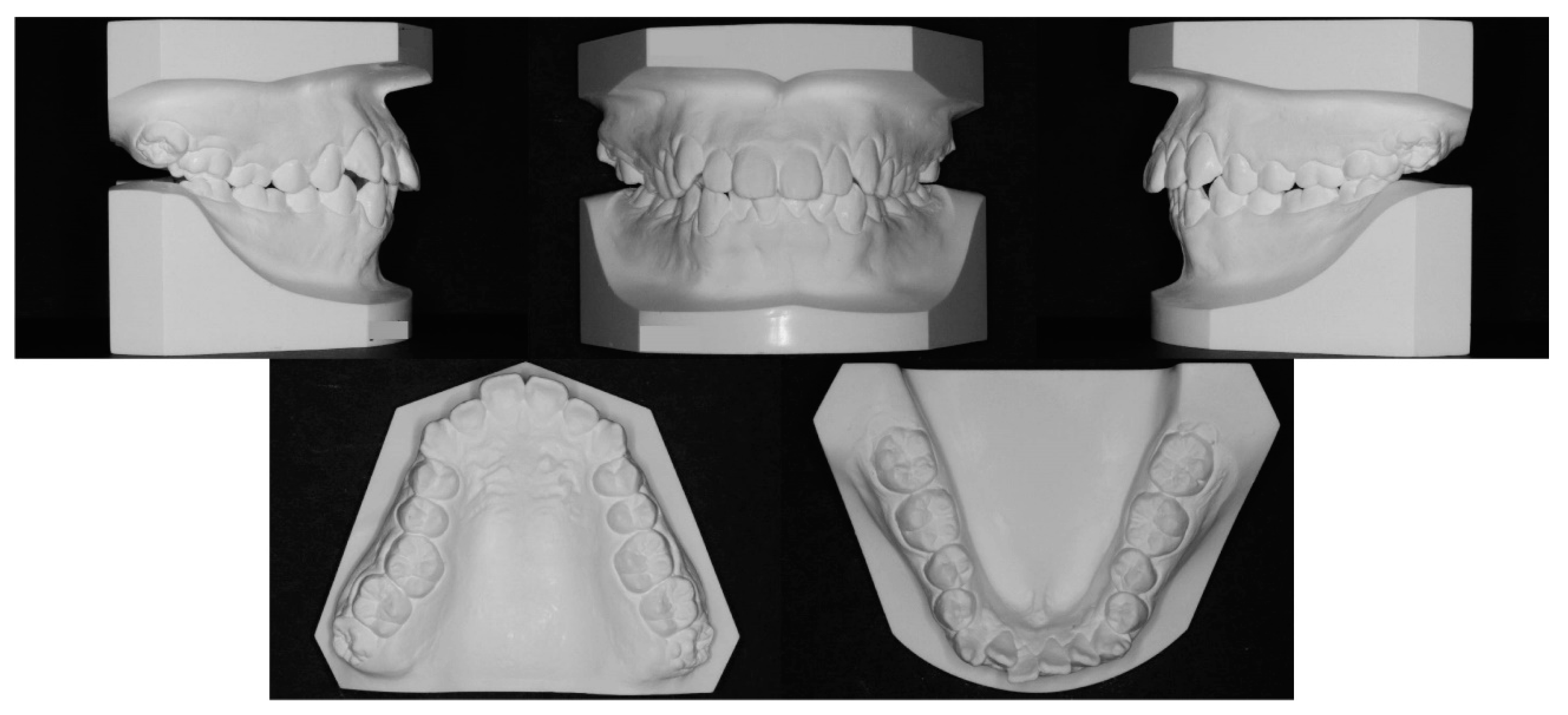 A Case Treated with Maxillary Molar Distalization through the Maxillary ...