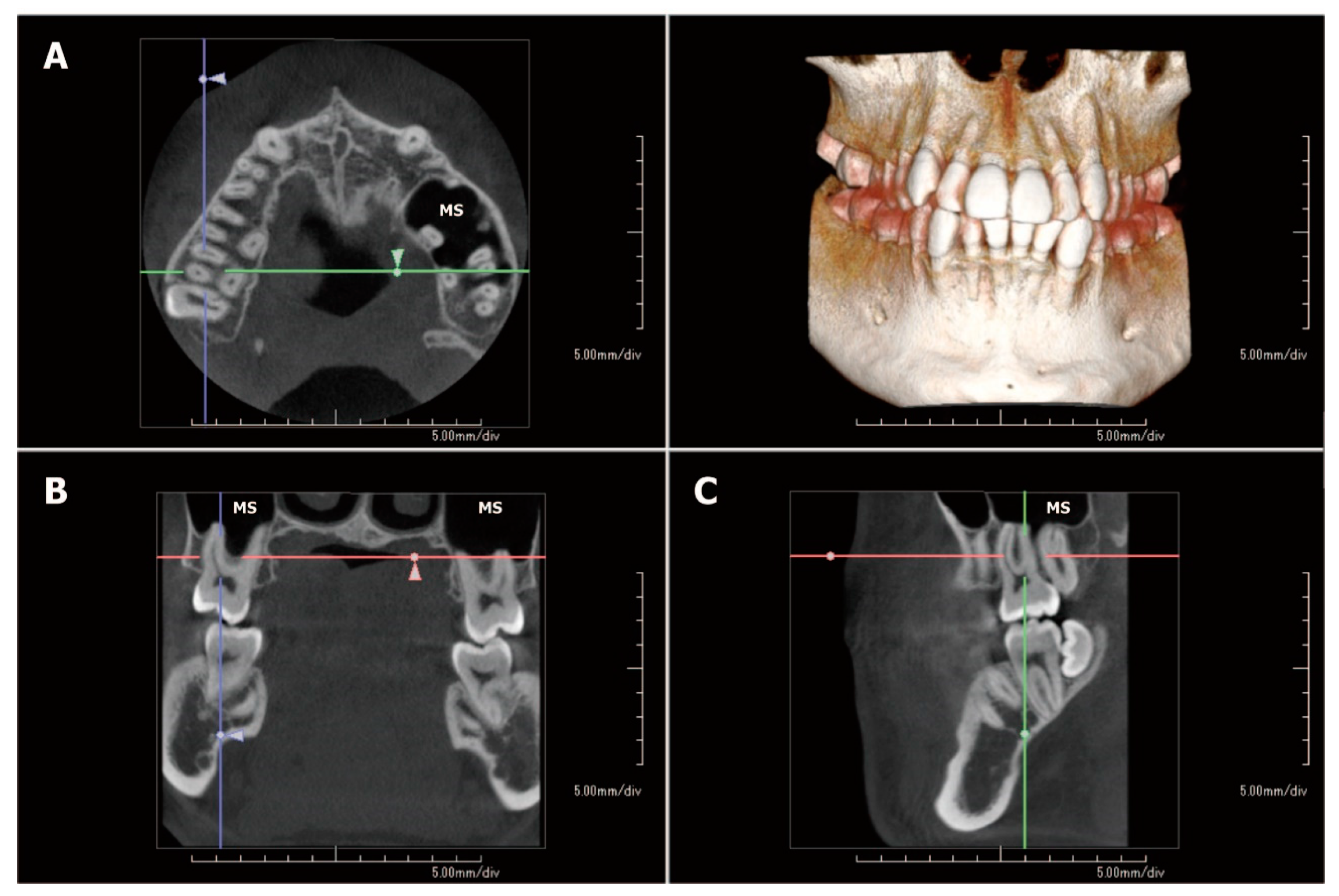 Applied Sciences Free Full Text A Case Treated With Maxillary Molar